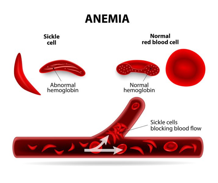 Sickle Cell Awareness Month: Some SCD Facts - Next Step Fund, Inc.